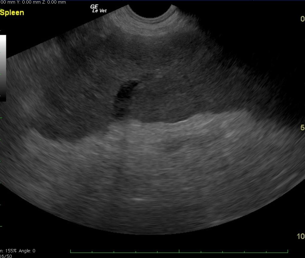 Acute and chronic hemorrhage secondary to splenic thrombosis in a 6 ...