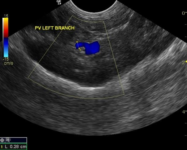 Gastric portocaval shunt and microvascular dysplasia (MVD) in a 4 year ...