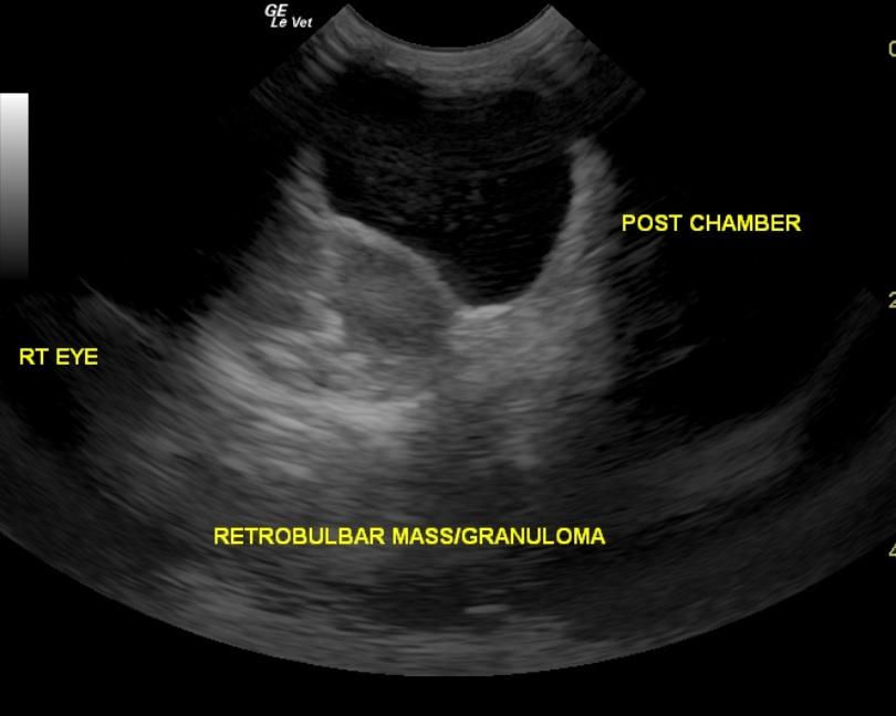 Retrobulbar carcinoma or adenocarcinoma diagnosed by FNA in a 12 year ...