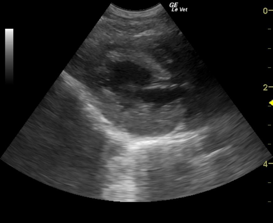 Mild systolic anterior motion (SAM) of the mitral valve in a 19 year ...