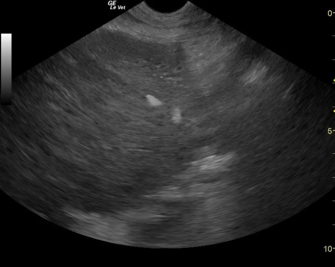 Gastritis, enteritis, post operative peritonitis with benign hepatic ...