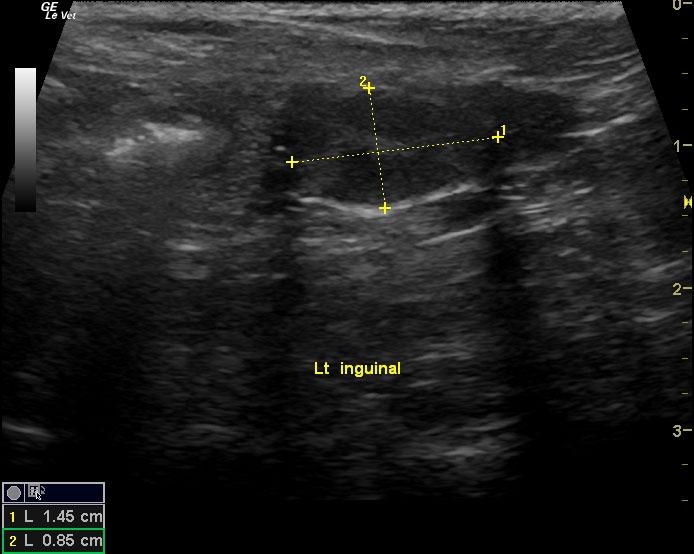 Benign prostatic hyperplasia and an inguinal testis (unilateral ...