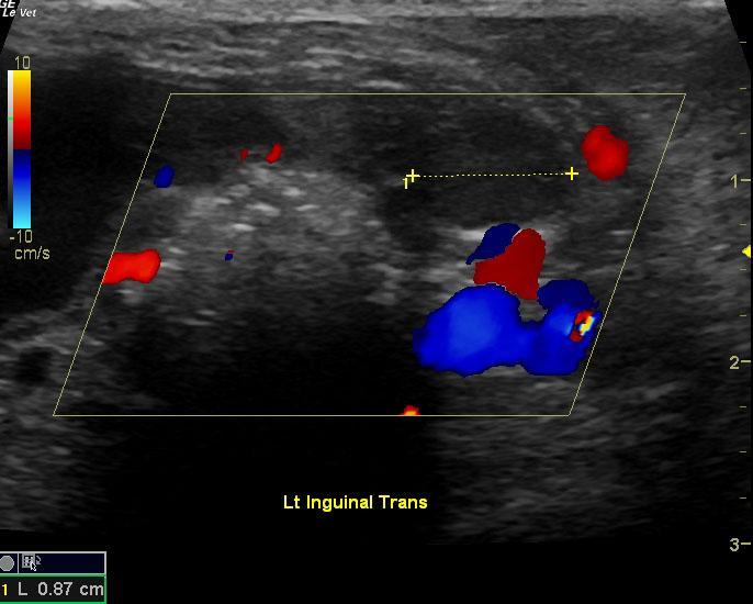 Benign prostatic hyperplasia and an inguinal testis (unilateral ...