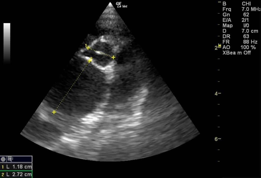 Stage C1 Valvular Disease, Mitral Valve Prolapse and Left Sided ...
