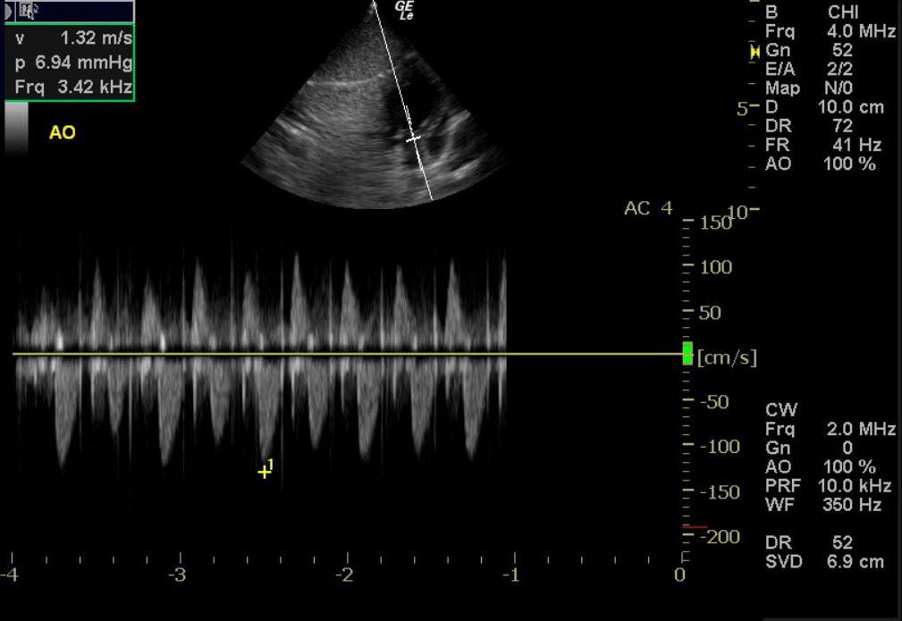 Dilated Cardiomyopathy (DCM)-like Syndrome Secondary to Parvoviral ...