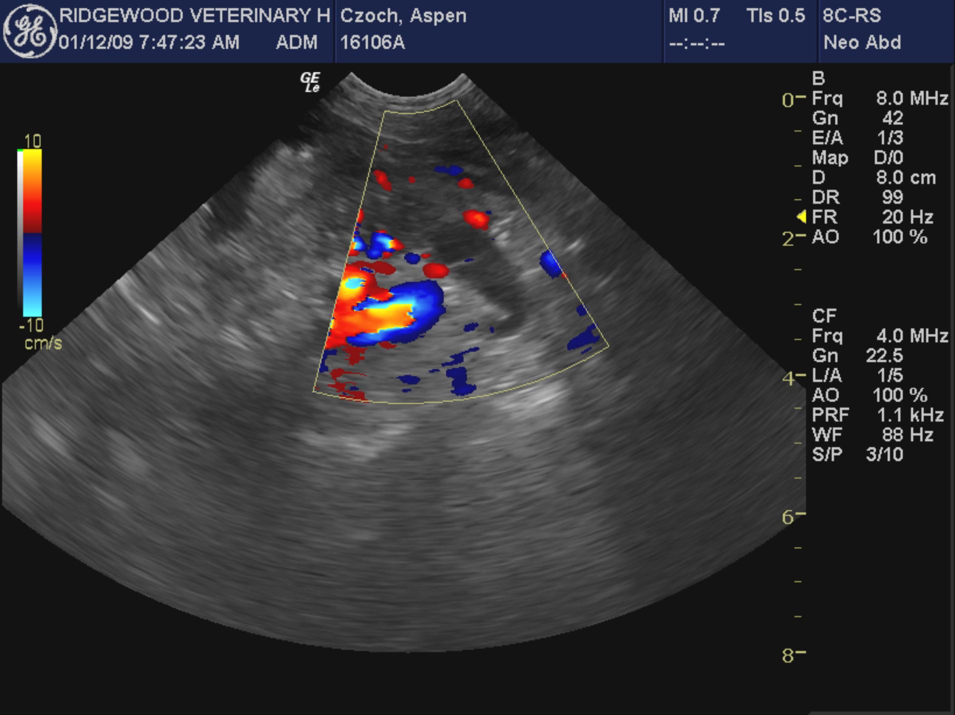 UGELAB (Laser Ablation) treatment for trigonal transitional cell ...