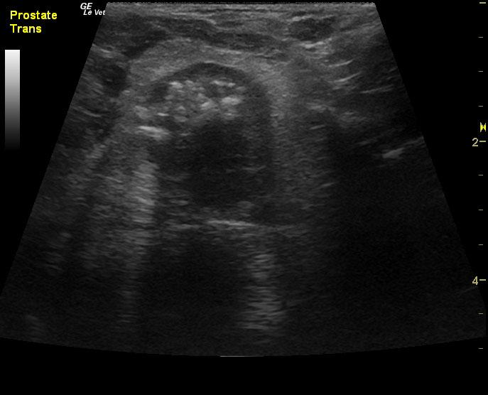 Prostatic carcinoma diagnosed by ultrasound-guided FNA in a 14 year old ...