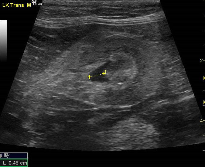 Pyelonephritis and interstitial nephrosis in a 16 year old FS cat - Members