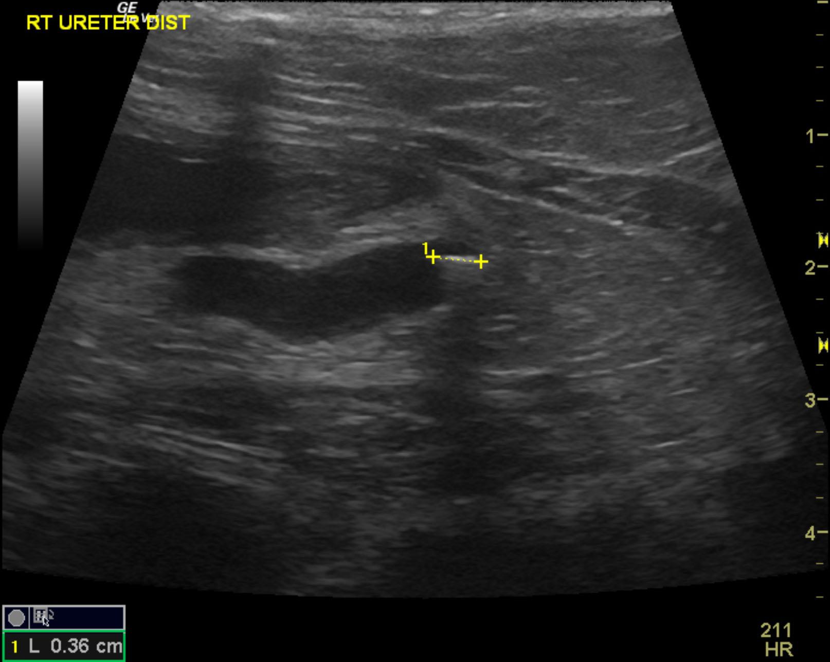 Ureterolith with hydronephrosis in a 15 year old FS DSH cat - Members