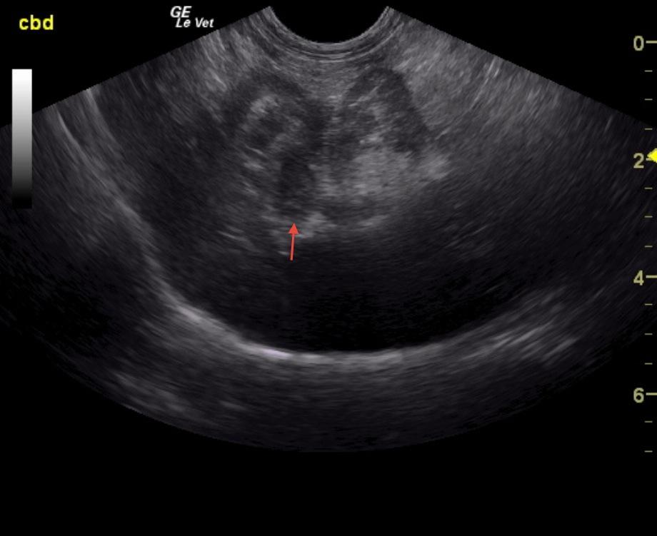 05_00140 Tubby T Acute on chronic pancreatitis leading to post hepatic ...