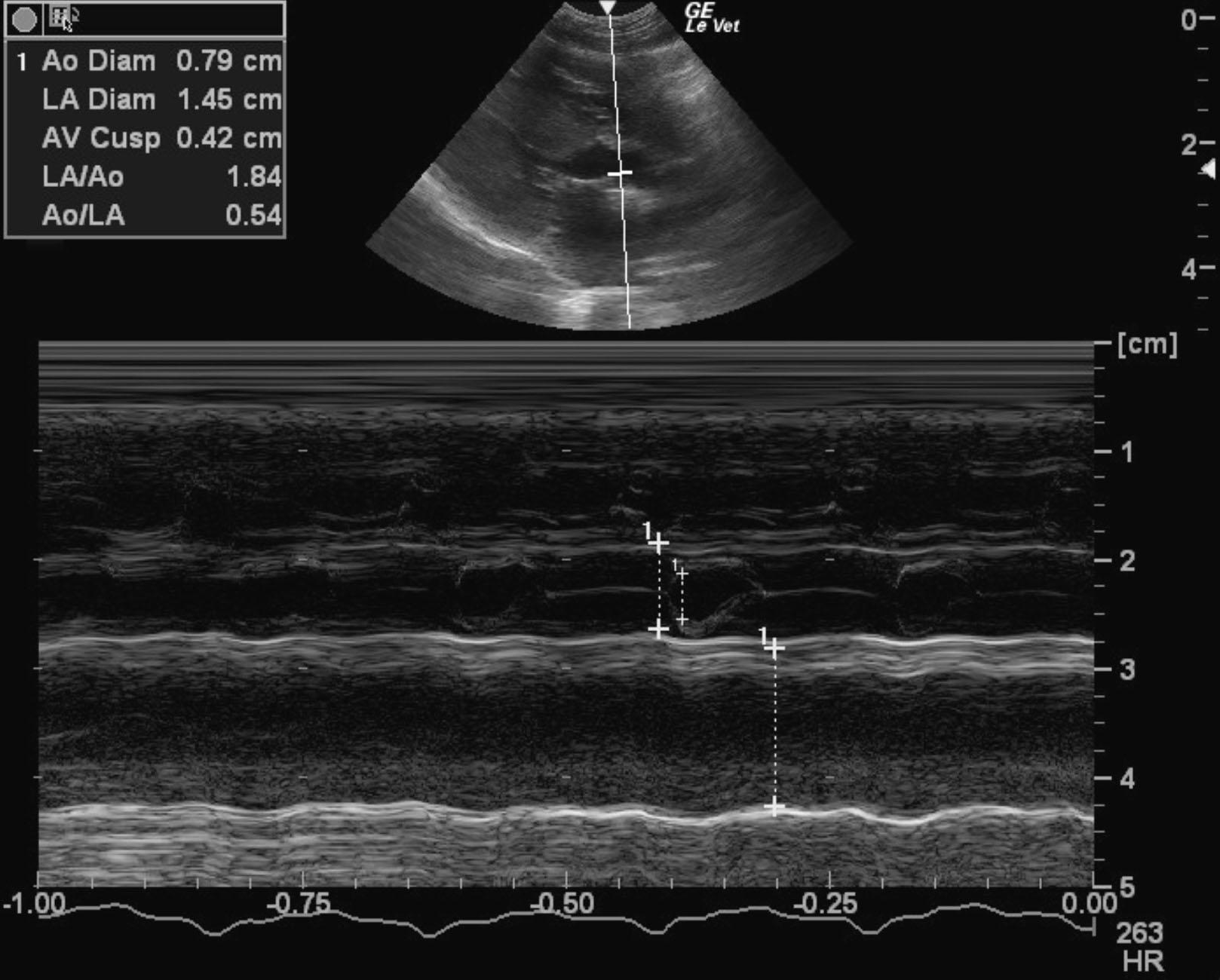 Hypertrophic cardiomyopathy (HCM) with myocardial failure and ...