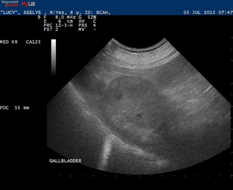 Gall bladder mucocele rupture?? - Members