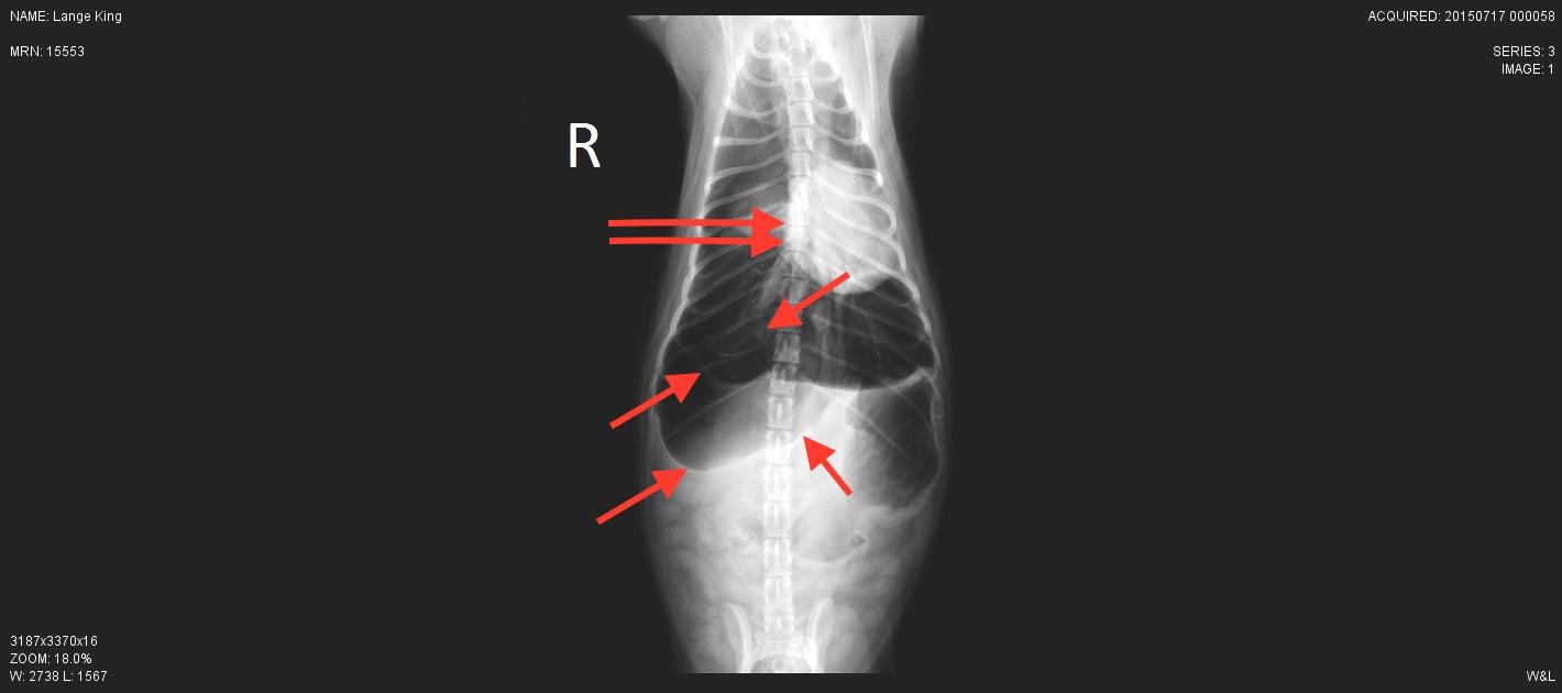 RADS - Bilateral Pneumothorax and Pulmonary Collapse in a 5 year old MN ...