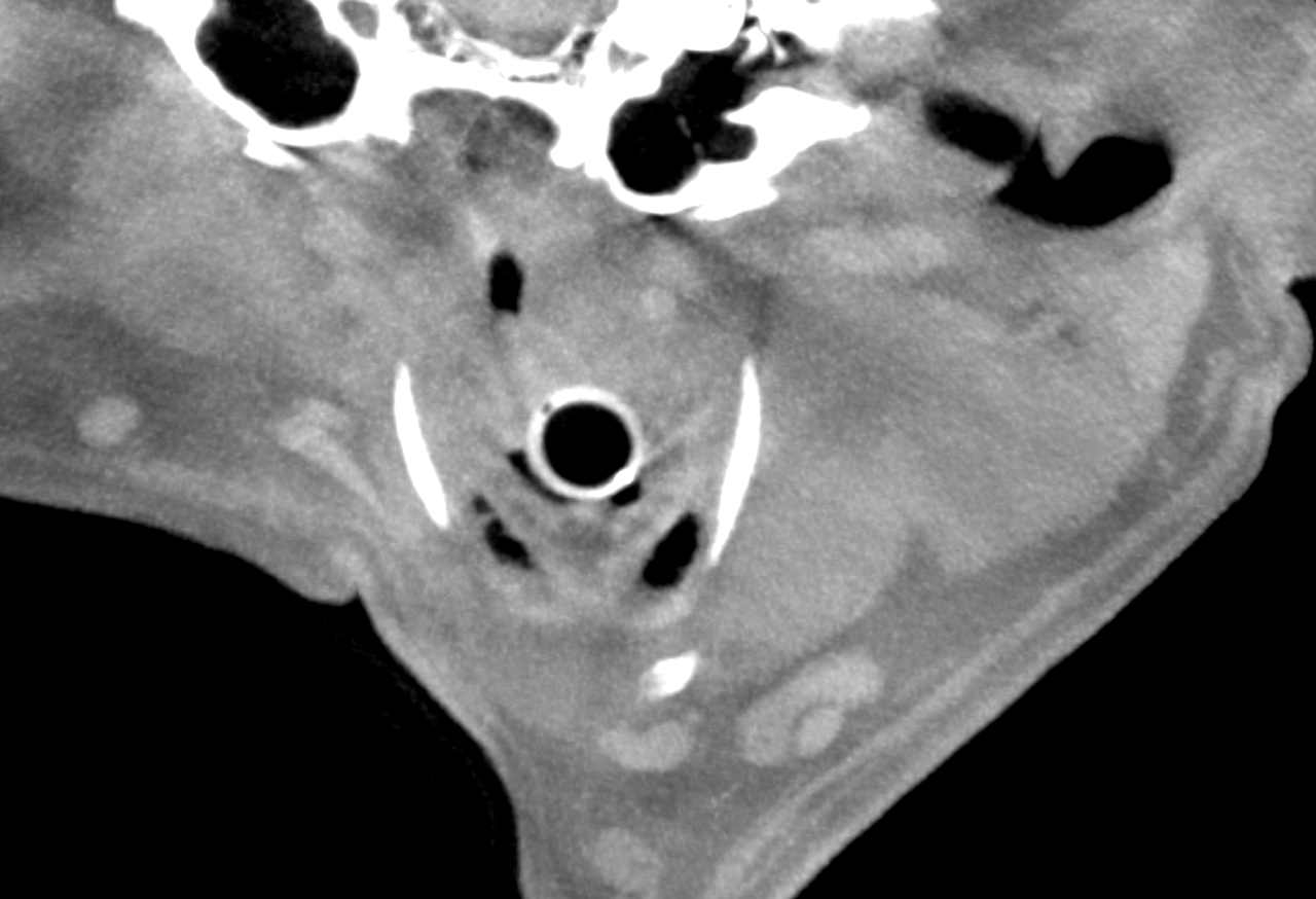 CT Laryngitis and Tonsilitis - Members