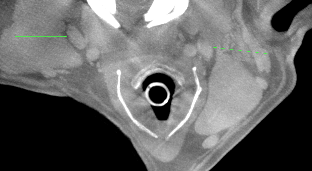 CT Laryngitis and Tonsilitis - Members