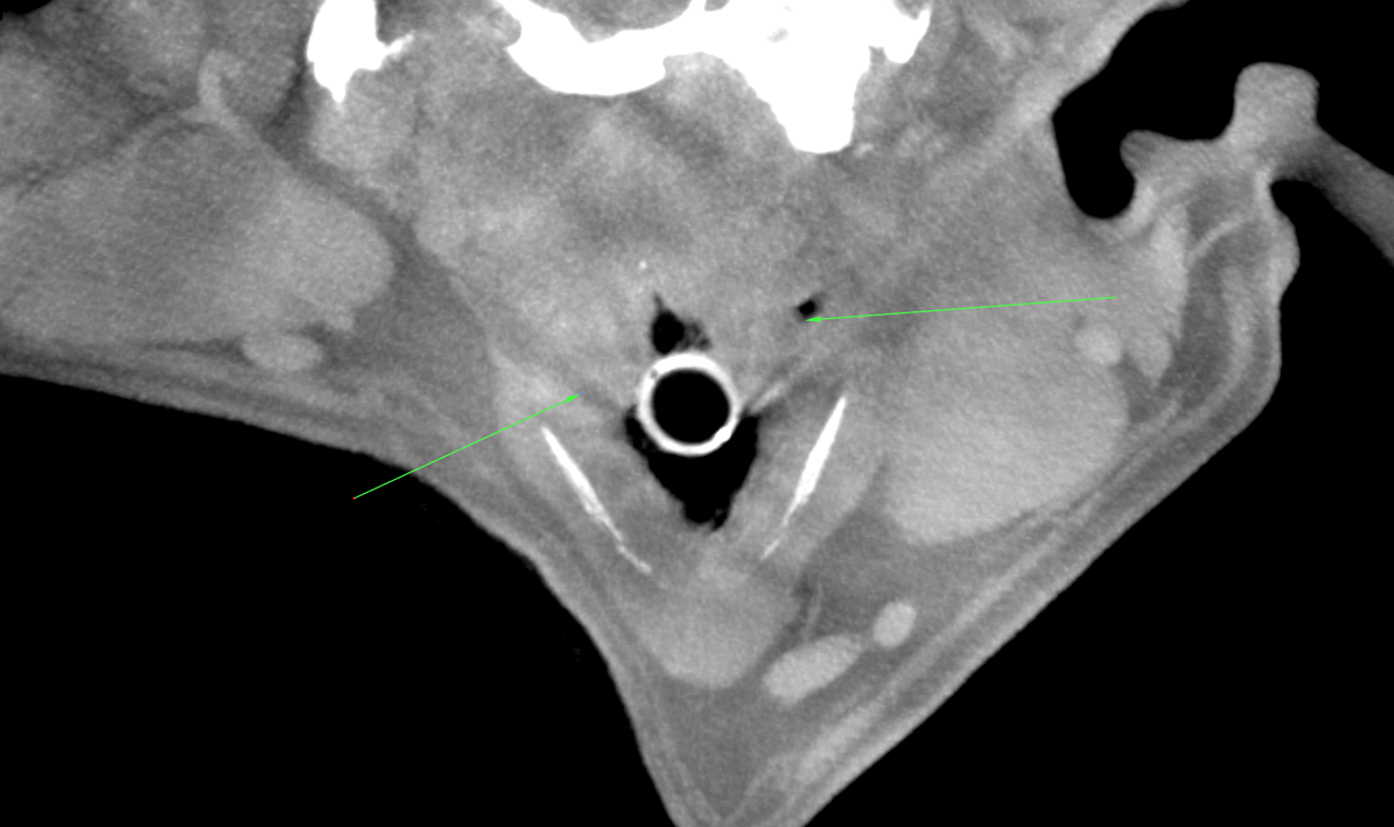 CT Laryngitis and Tonsilitis - Members