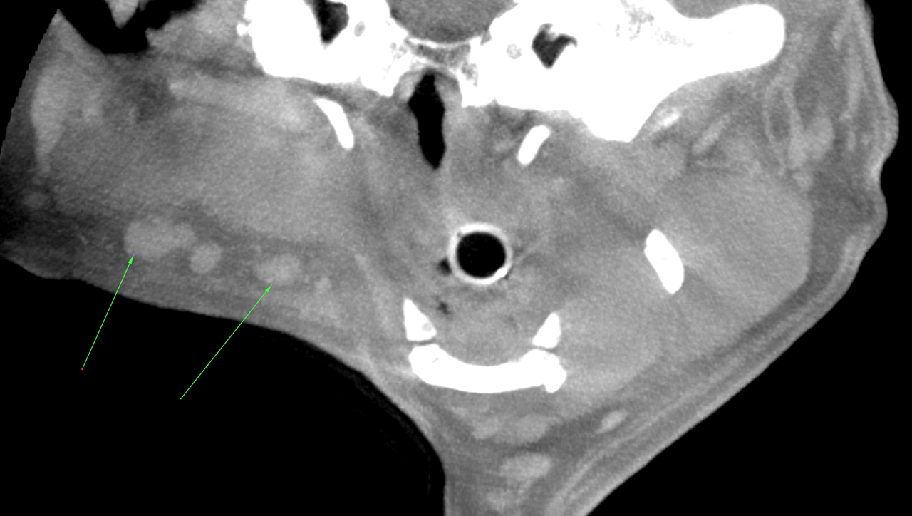CT Laryngitis and Tonsilitis - Members