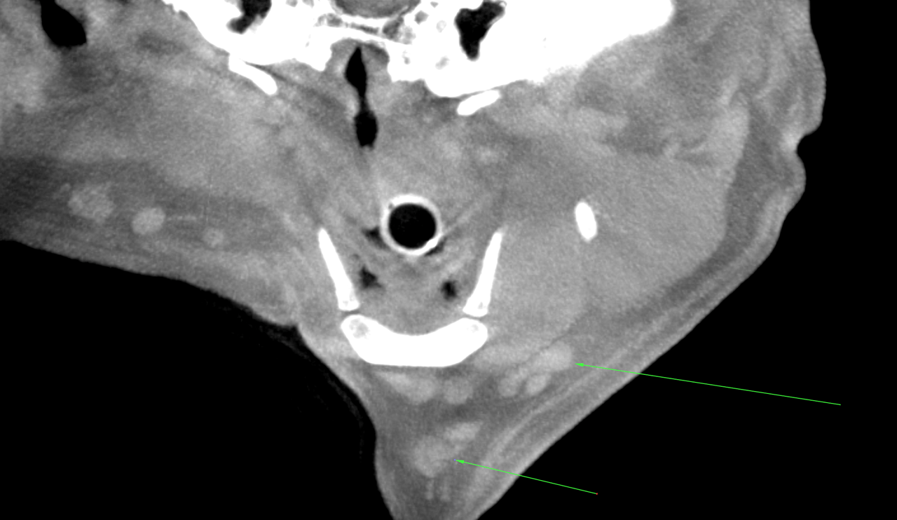CT Laryngitis and Tonsilitis - Members