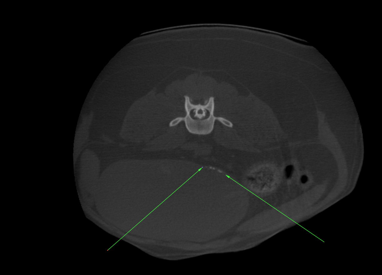 CT Disc Extrusion with Mild Myelocompression and Spinal Cord Swelling ...