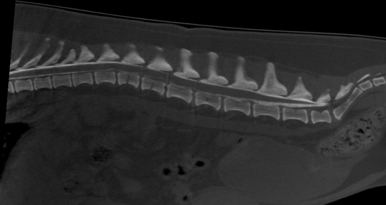 CT Disc Extrusion with Mild Myelocompression and Spinal Cord Swelling ...