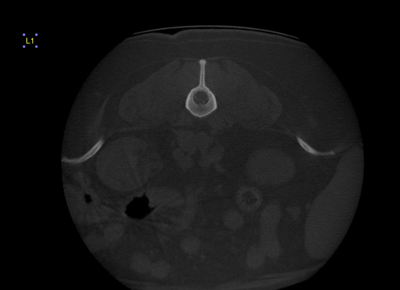 CT Disc Extrusion with Mild Myelocompression and Spinal Cord Swelling ...