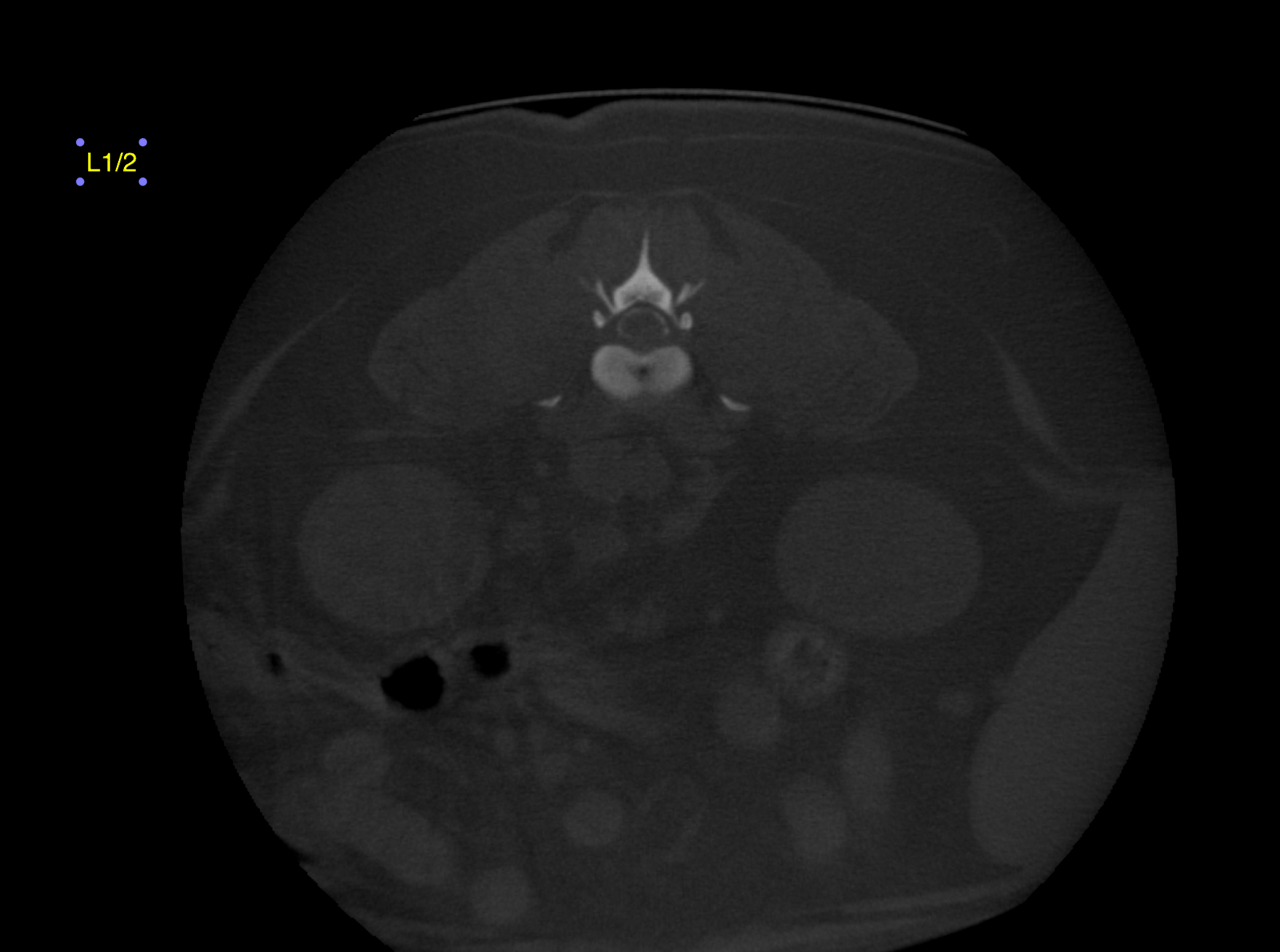CT Disc Extrusion with Mild Myelocompression and Spinal Cord Swelling ...