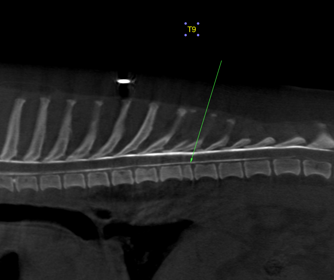 CT Disc Extrusion with Mild Myelocompression and Spinal Cord Swelling ...