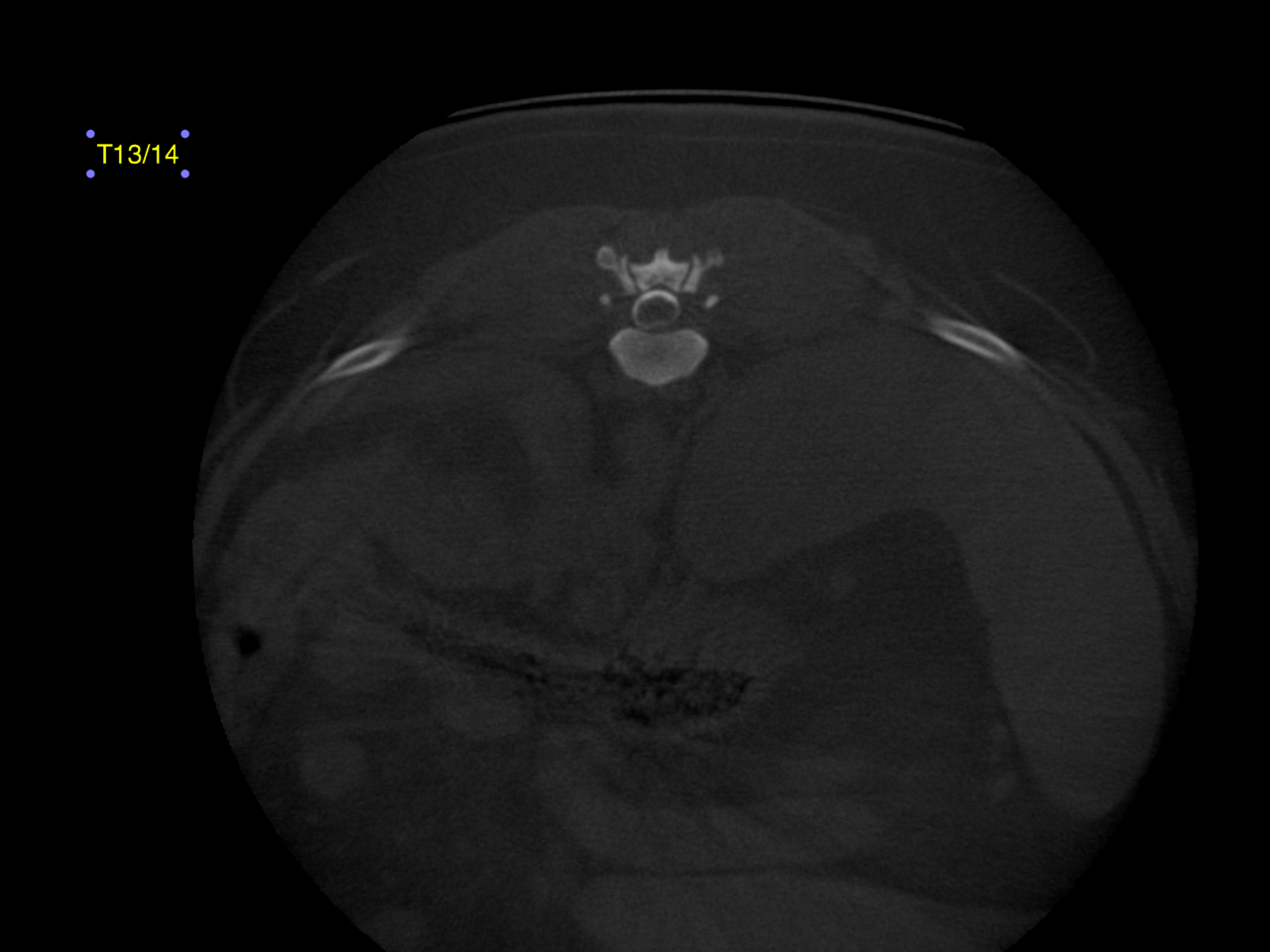 CT Disc Extrusion with Mild Myelocompression and Spinal Cord Swelling ...
