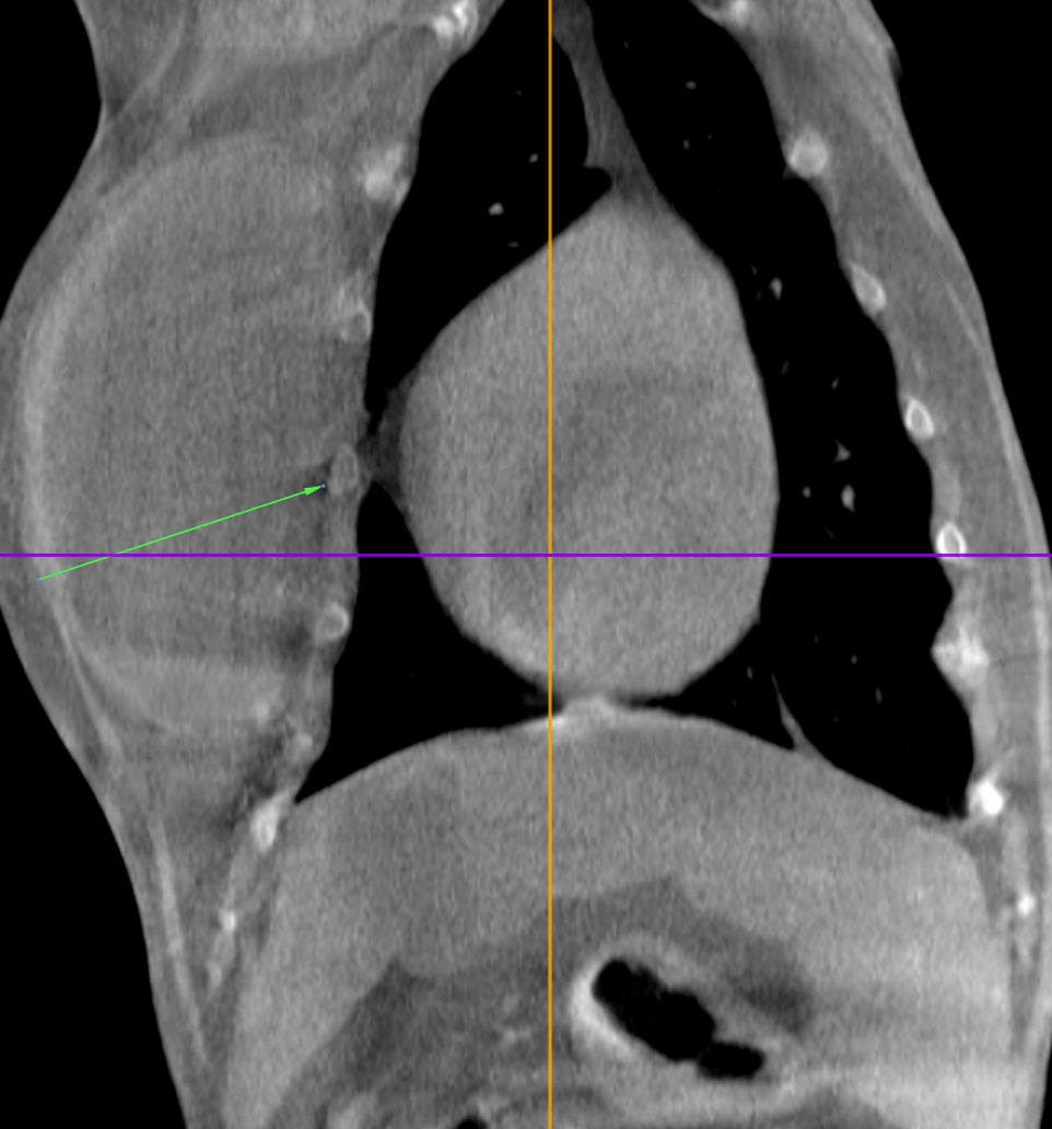 CT Mesenchymal Soft Tissue Neoplasia on Thoracic Wall, with Reactive ...