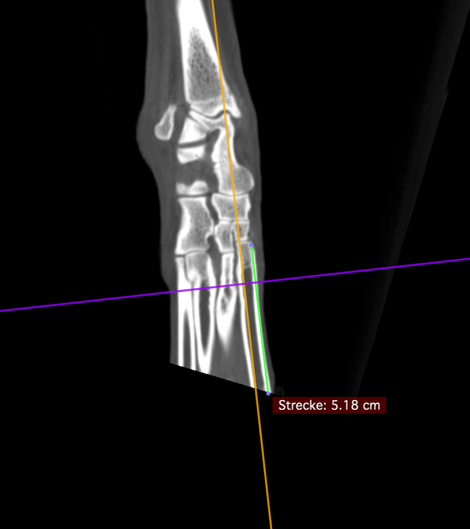 Ct Congenital Oligodactylic Malformation Of Rear Limb With Phalangeal