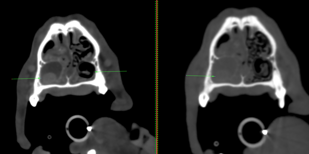 CT - Bilateral Chronic Rhinitis with Conchal Lysis in a 6 year old MN ...