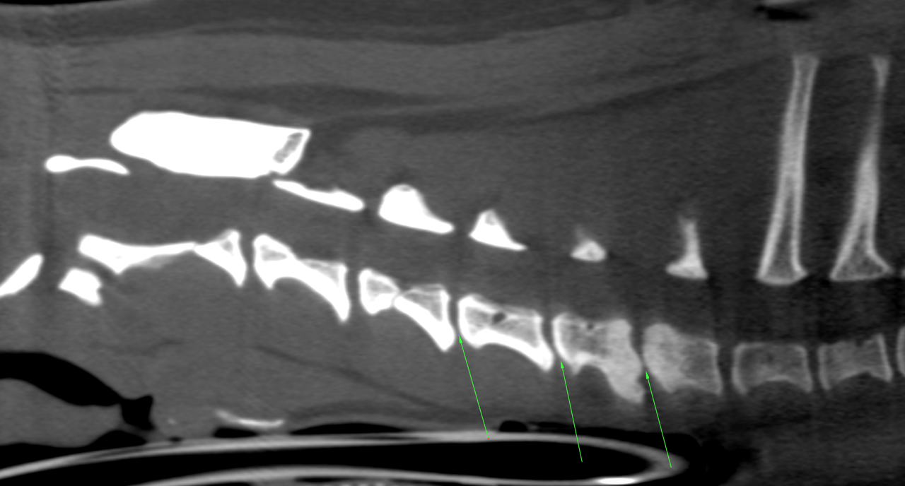 CT- Chronic Cervical Disc Protrusion with Compressive Myelopathy and ...