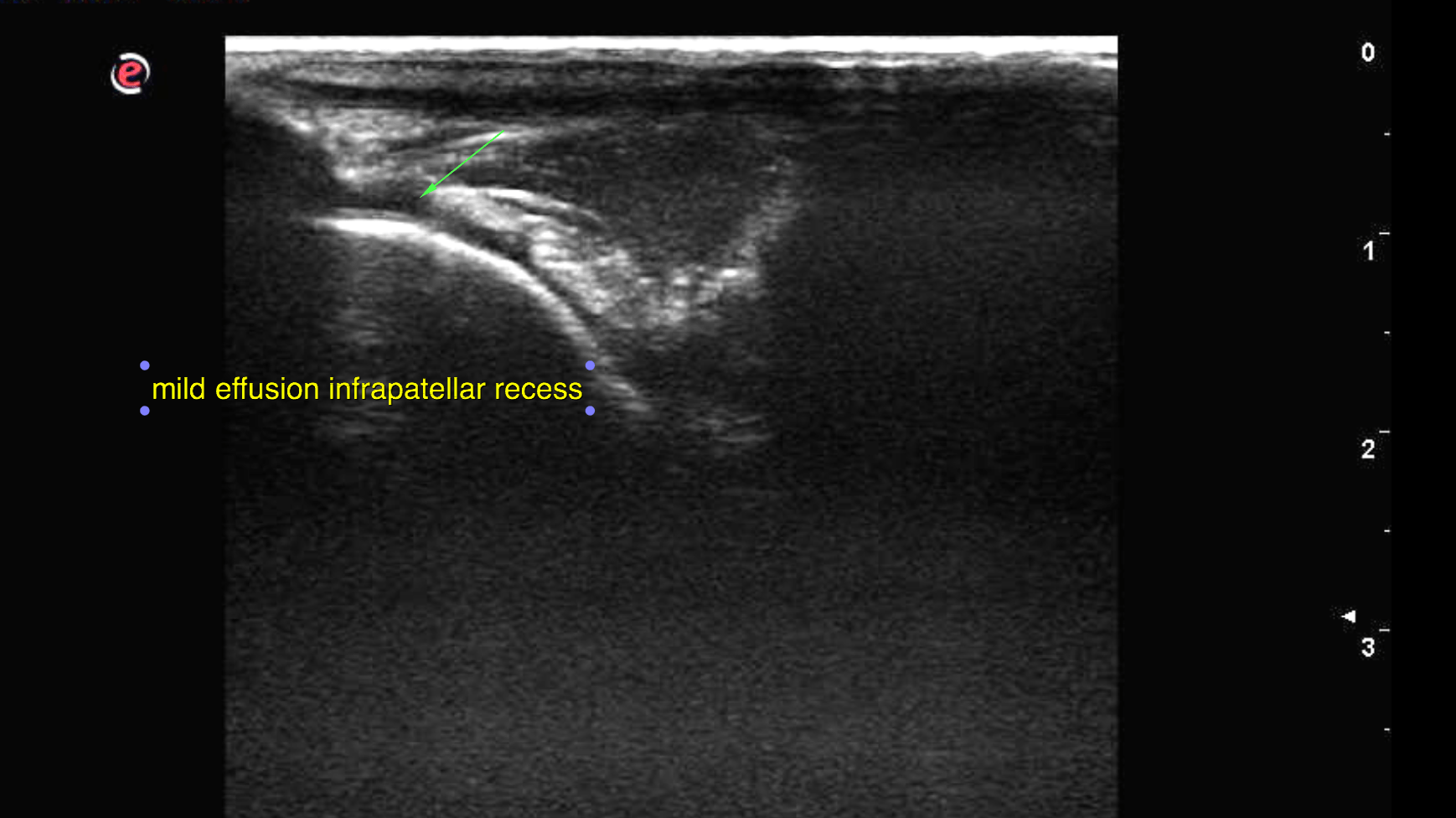 ORTHO - Partial Cranial Cruciate Ligament (CCL) Rupture and Chronic ...