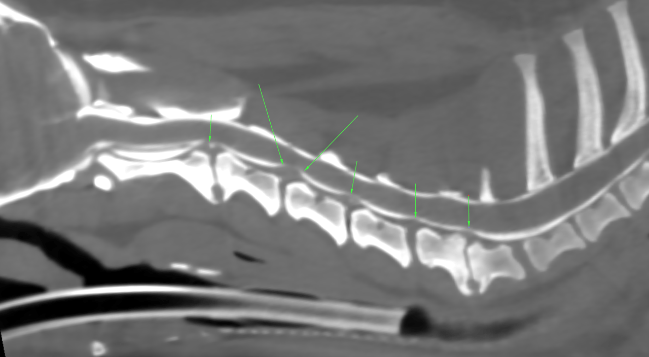 CT - Cervical Disc Herniation Multiple Sites with Compressive ...