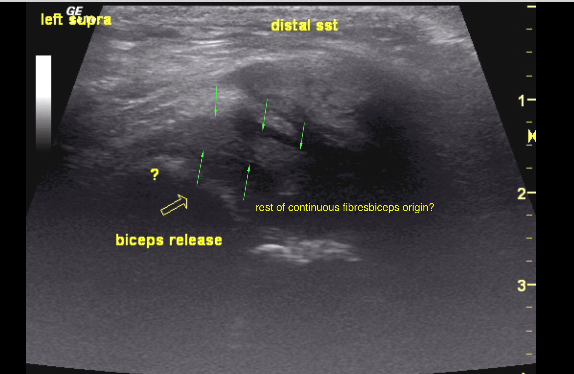 ORTHO - Incomplete Biceps Tendon Release with Tenosynovitis and ...