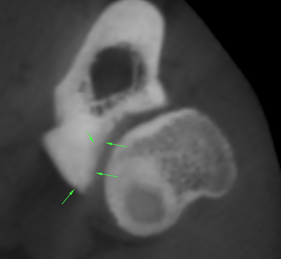 CT - Fissuring of the Medial Coronoid Process and Emerging ...