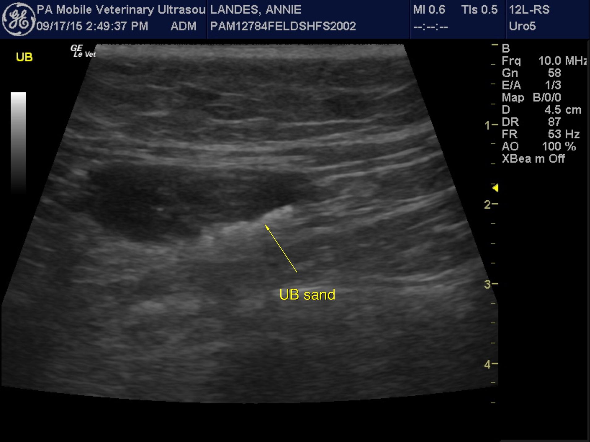 Cholecystolithiasis Cholangitis With Post Hepatic Obstruction And Pancreatitis In A 13 Year