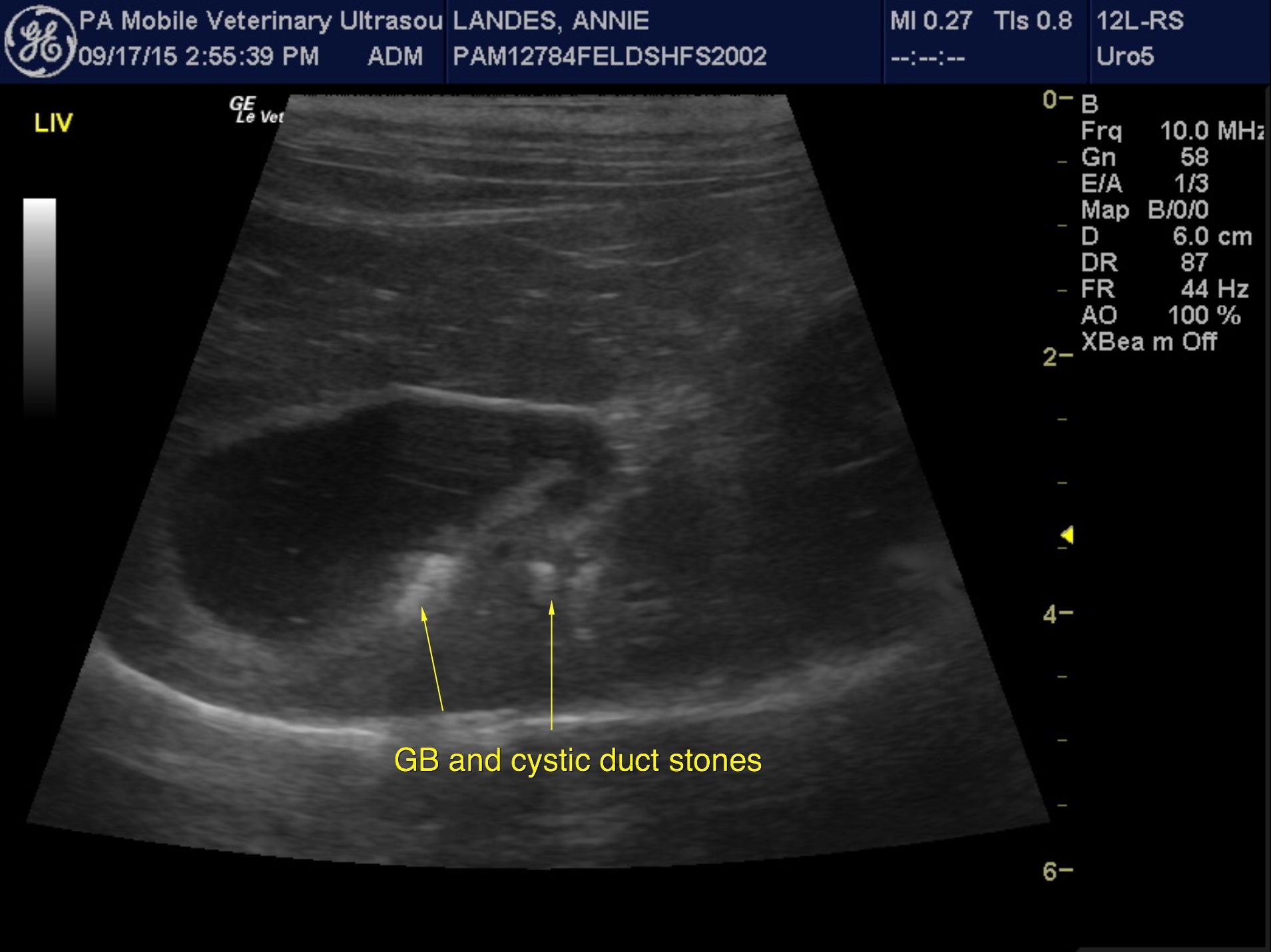 Cholecystolithiasis Cholangitis With Post Hepatic Obstruction And Pancreatitis In A 13 Year