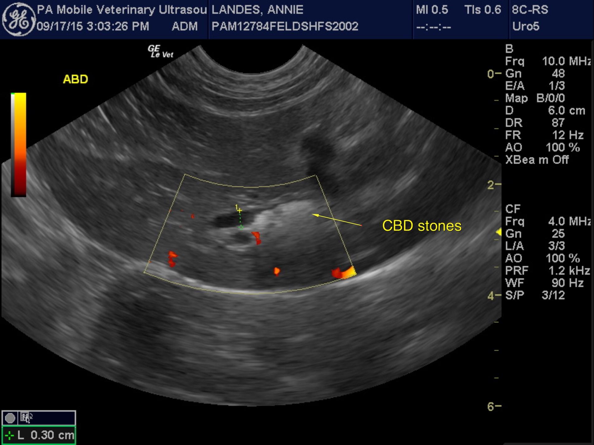 Cholecystolithiasis Cholangitis With Post Hepatic Obstruction And Pancreatitis In A 13 Year