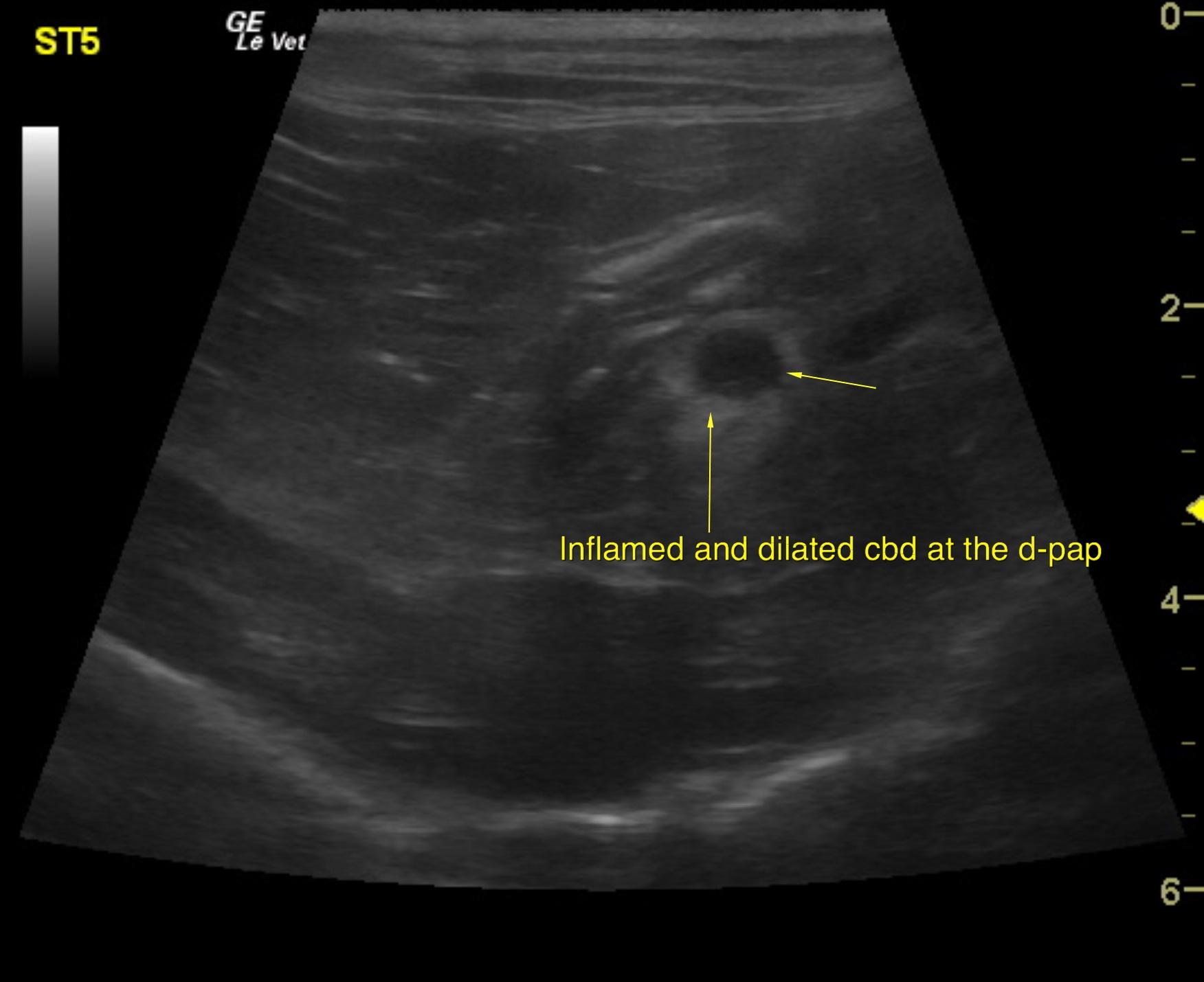 Cholecystolithiasis Cholangitis With Post Hepatic Obstruction And Pancreatitis In A 13 Year