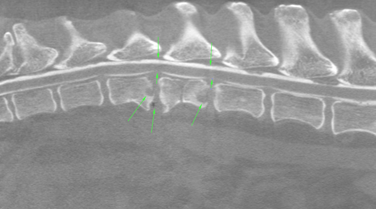 CT - Multifocal Chronic Discospondylitis with Compressive Myelopathy in ...