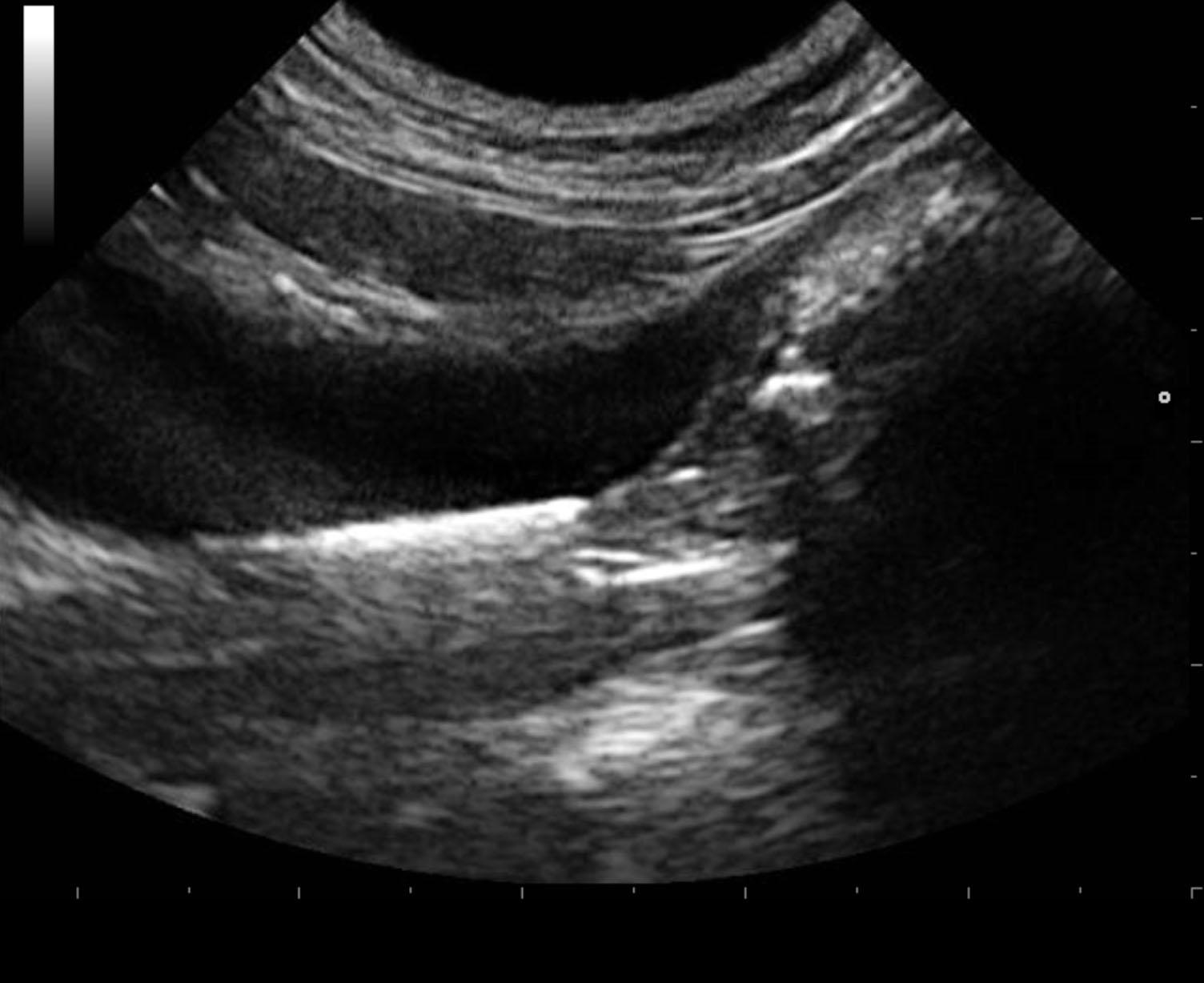 06_00314 Bella B Le ureteral obstruction - Members