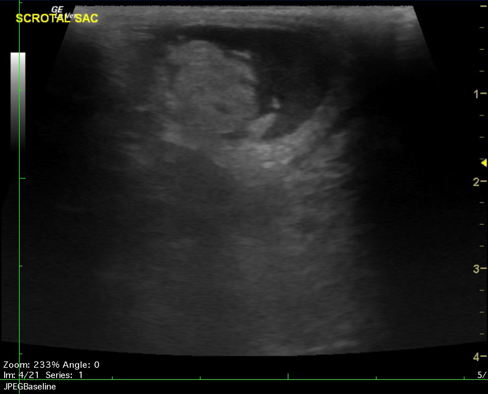 11_00055 Brody D Inguinal hernia - Members