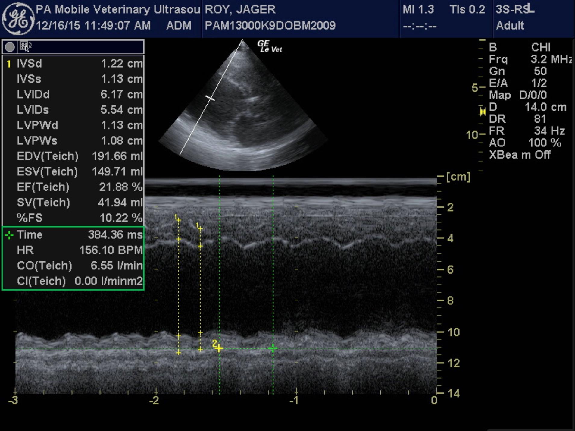 Congestive heart failure due to dilated cardiomyopathy (DCM) in a 6 ...