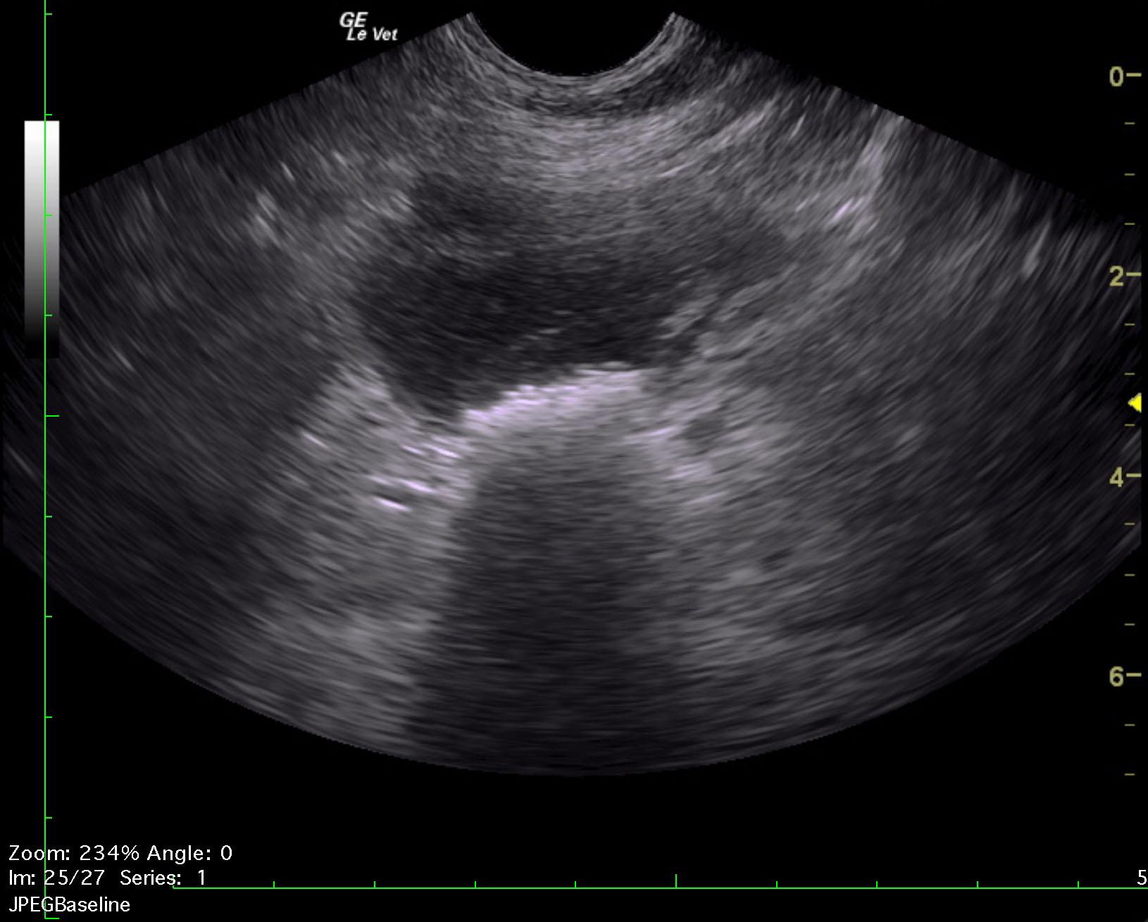 09-00158 Napoleon R Severe prostatitis, abscessation, possible ...