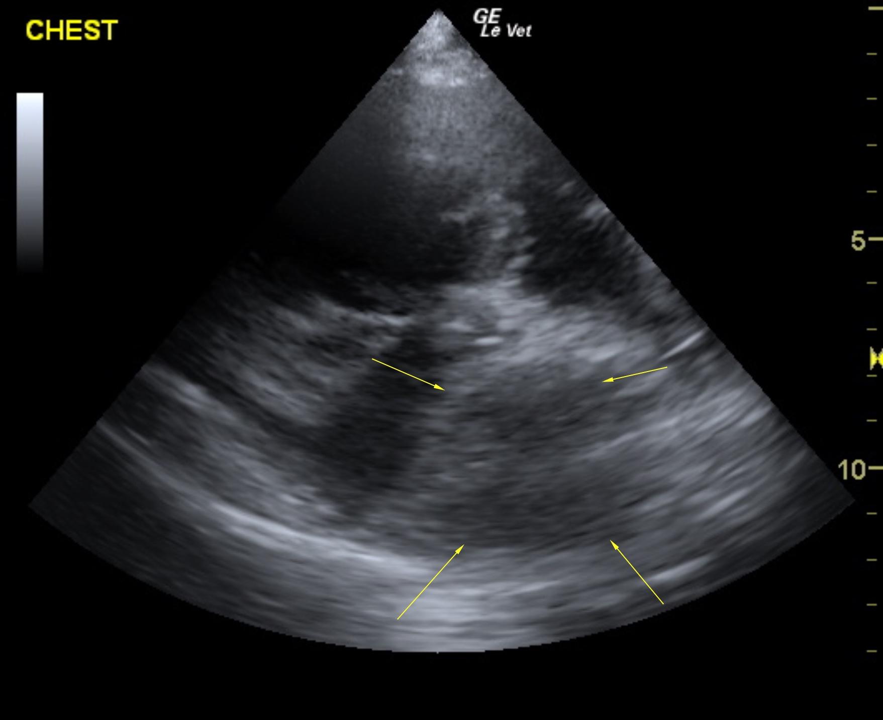 15-00220 Thunder G Heartbase mass with caval obstruction, MI, TI ...