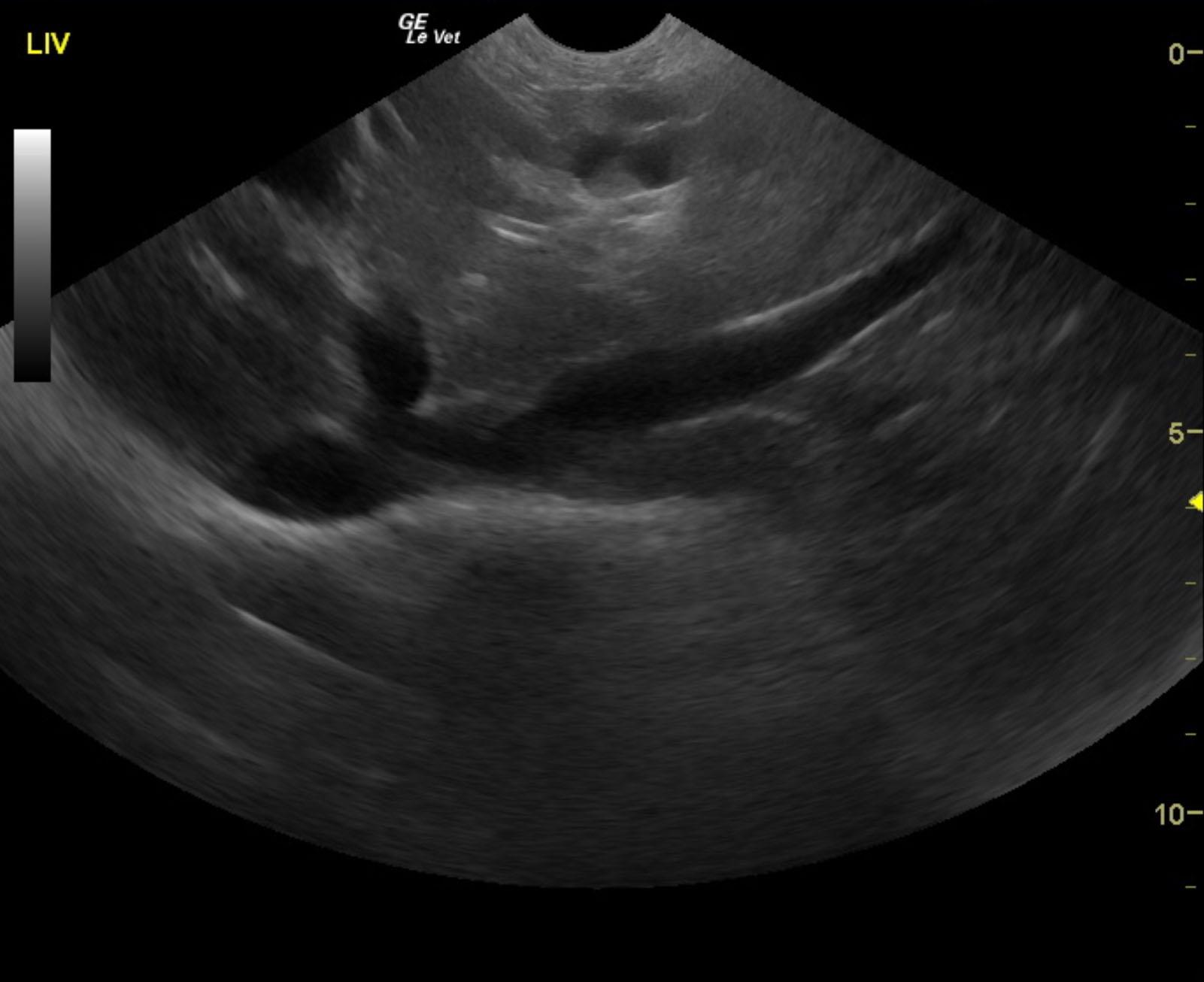 15-00220 Thunder G Heartbase mass with caval obstruction, MI, TI ...