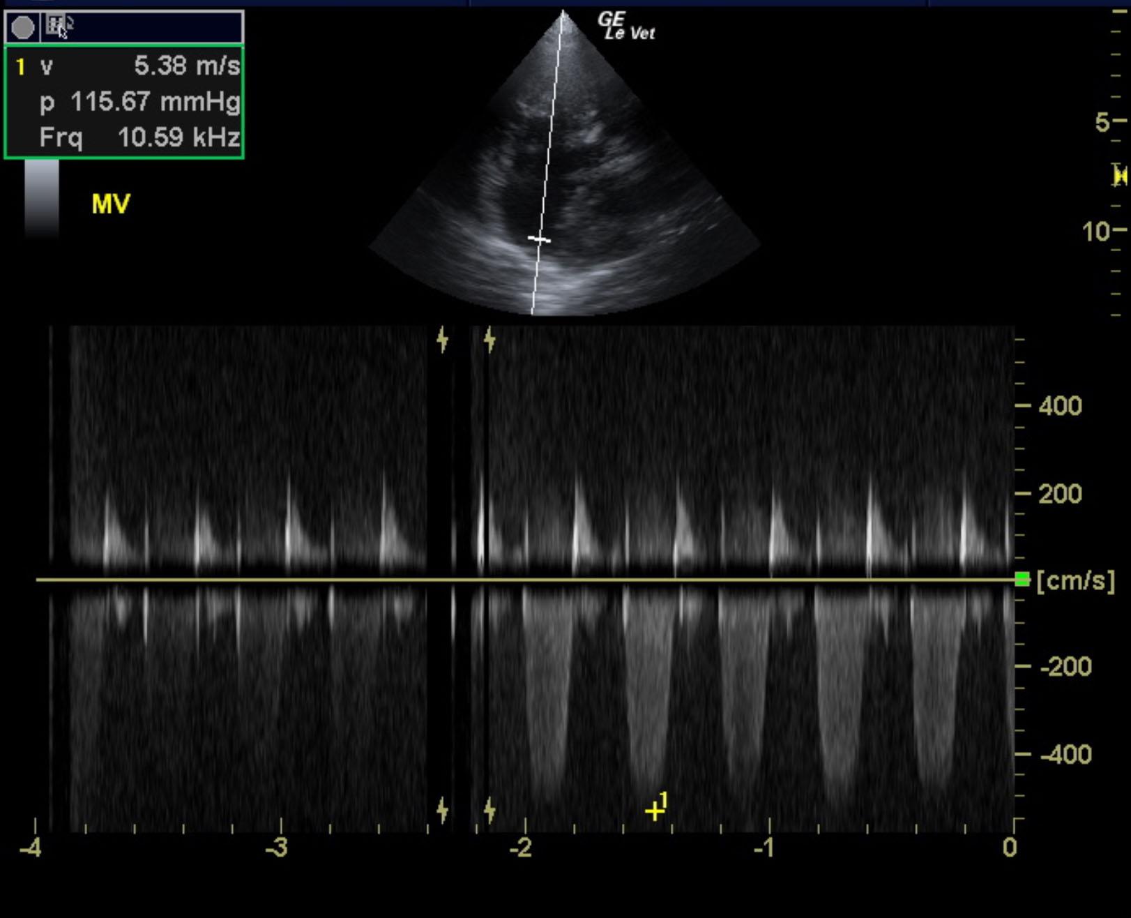 15-00220 Thunder G Heartbase mass with caval obstruction, MI, TI ...