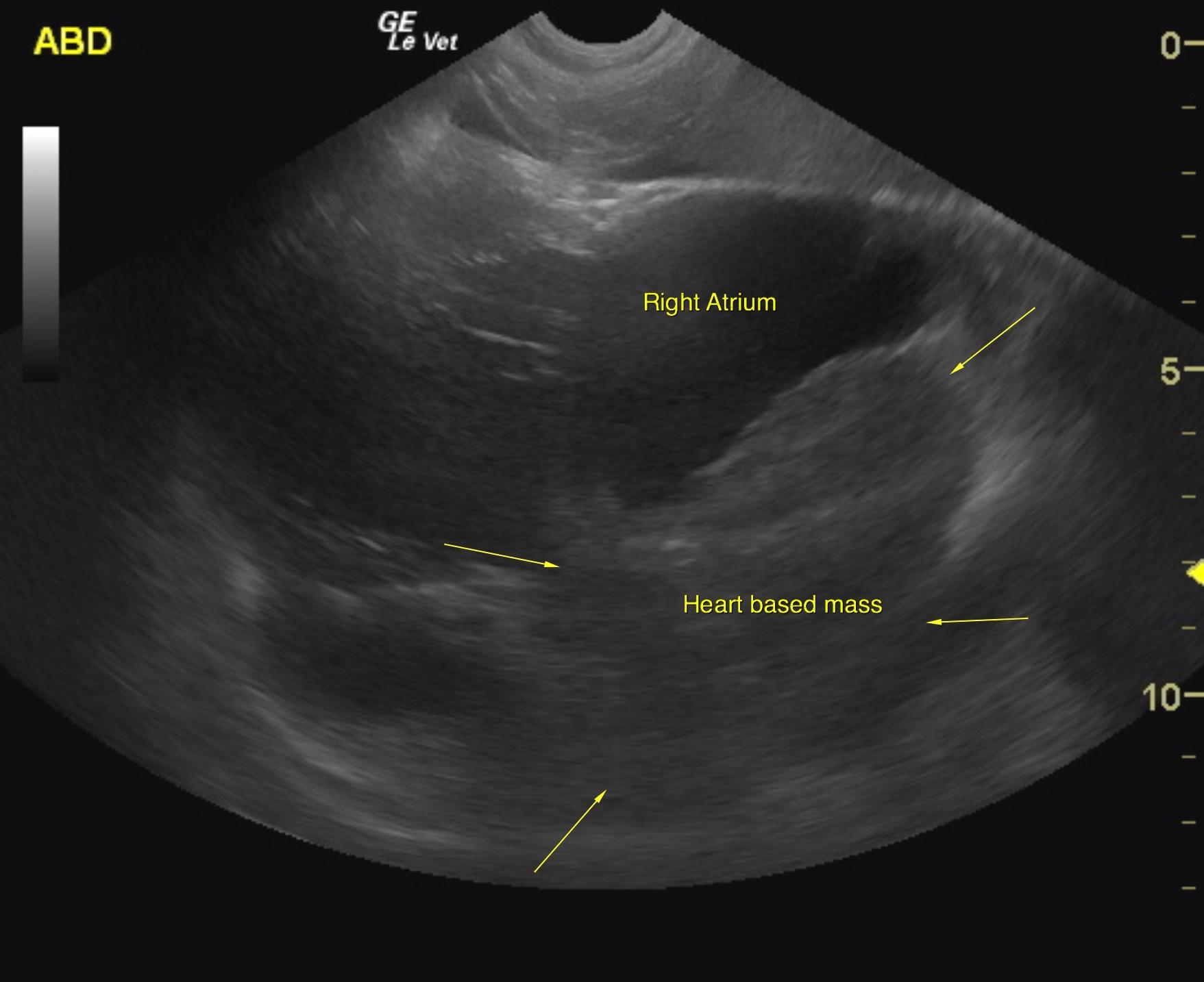 15-00220 Thunder G Heartbase mass with caval obstruction, MI, TI ...