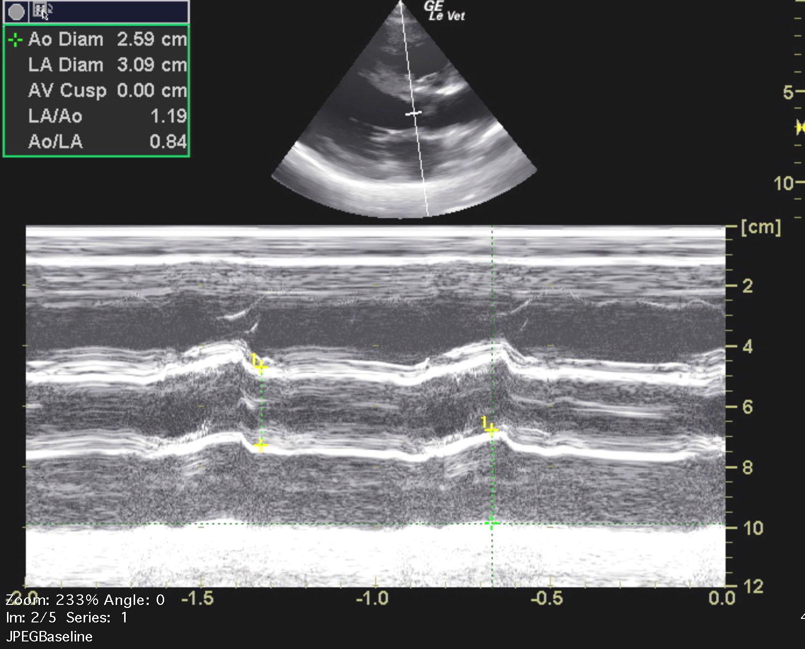 15-00222 Tilly E Subaortic stenosis and aortic regurg - Members